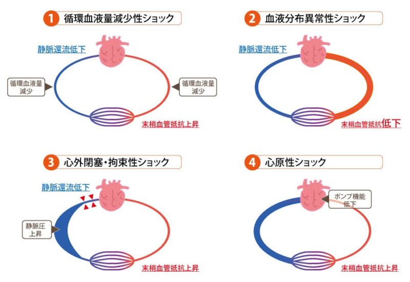 ショックの4つの分類と初期対応
