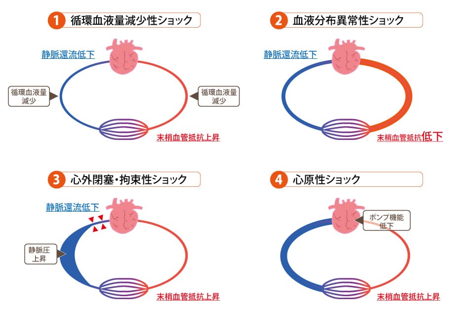 ショックの4つの分類と初期対応
