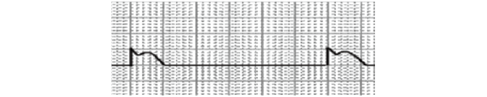心肺停止時は必ず除細動？PEAやVTなど心電図波形のポイント